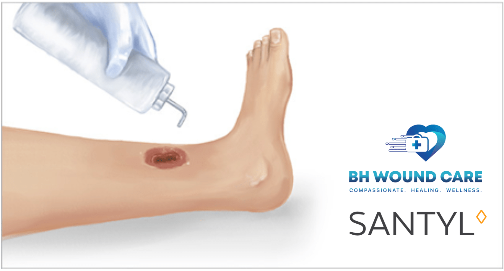 Santyl: Advanced Wound Healing Treatment in USA