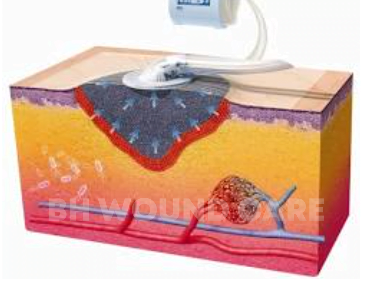 Vacuum Assisted Closure Negative Pressure Wound Therapy at Rosendo ...